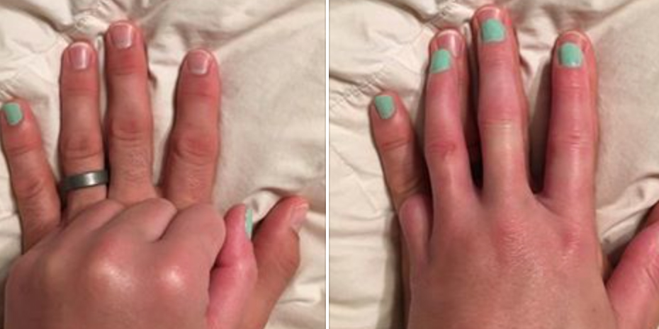 This husband's kind gesture for his wife who lost her pinky is going ...