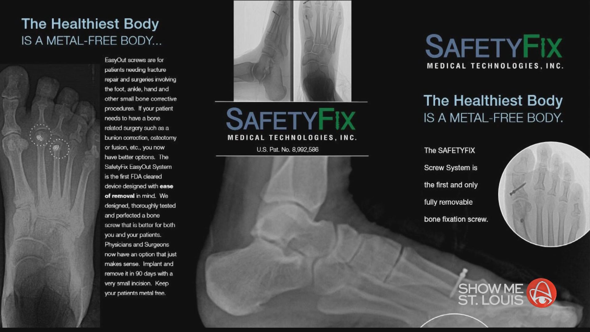 Safety Fix Easy Out Bone Screw | ksdk.com