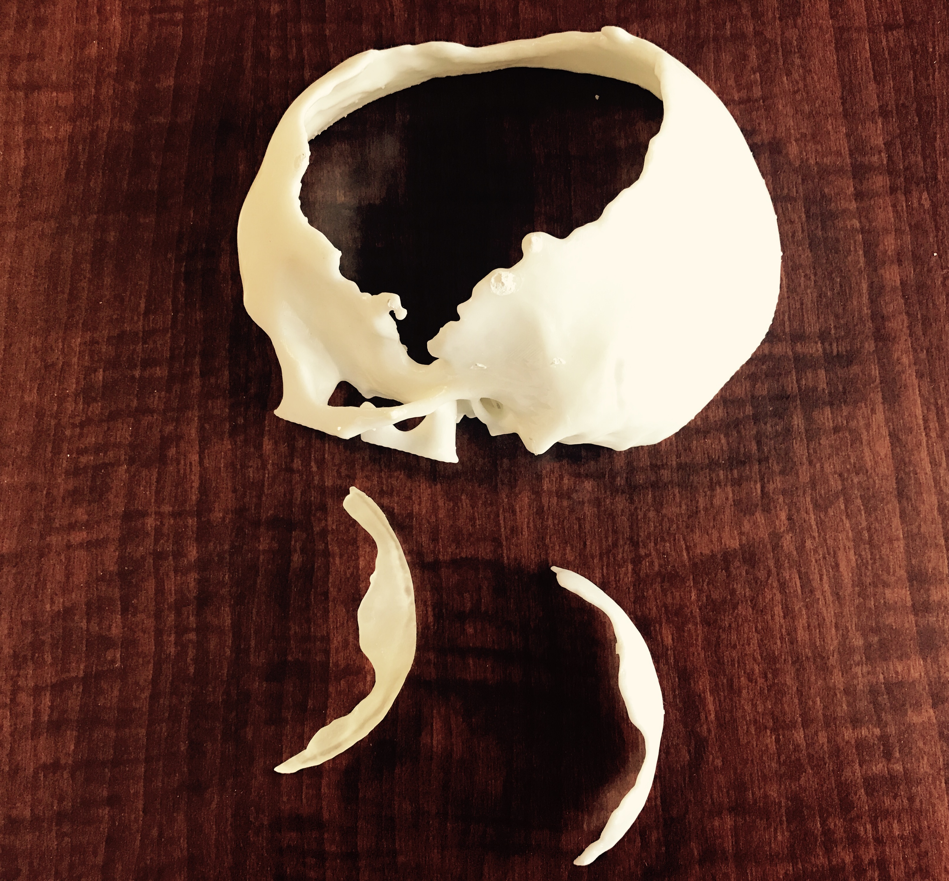 Surgeons use 3-D printed surgical guide on 2-year-old's skull | ksdk.com